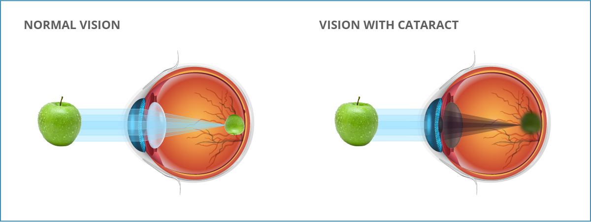 Best Adult’s Cataract treatment in Bahrain | Best Cataract Surgery in ...