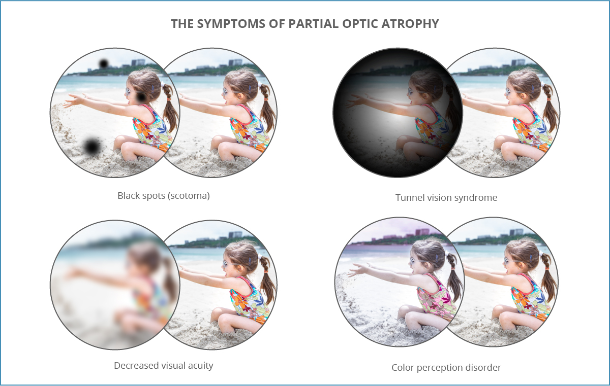 Best partial optic atrophy treatment Bahrain | Crystal Vision Eye ...